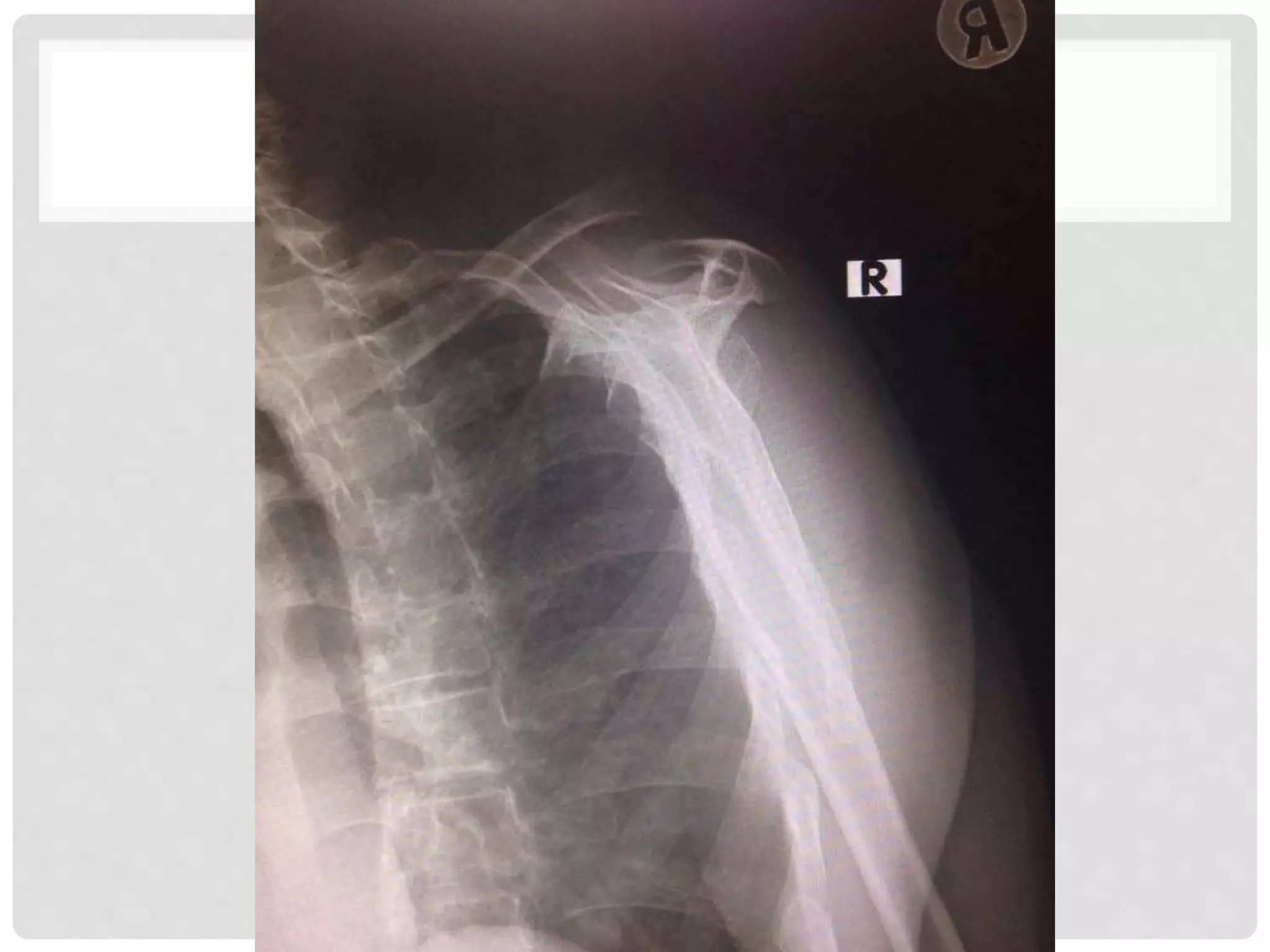 Acromioclavicular joint injury | PPTX