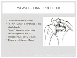 Acromioclavicular joint injury | PPTX