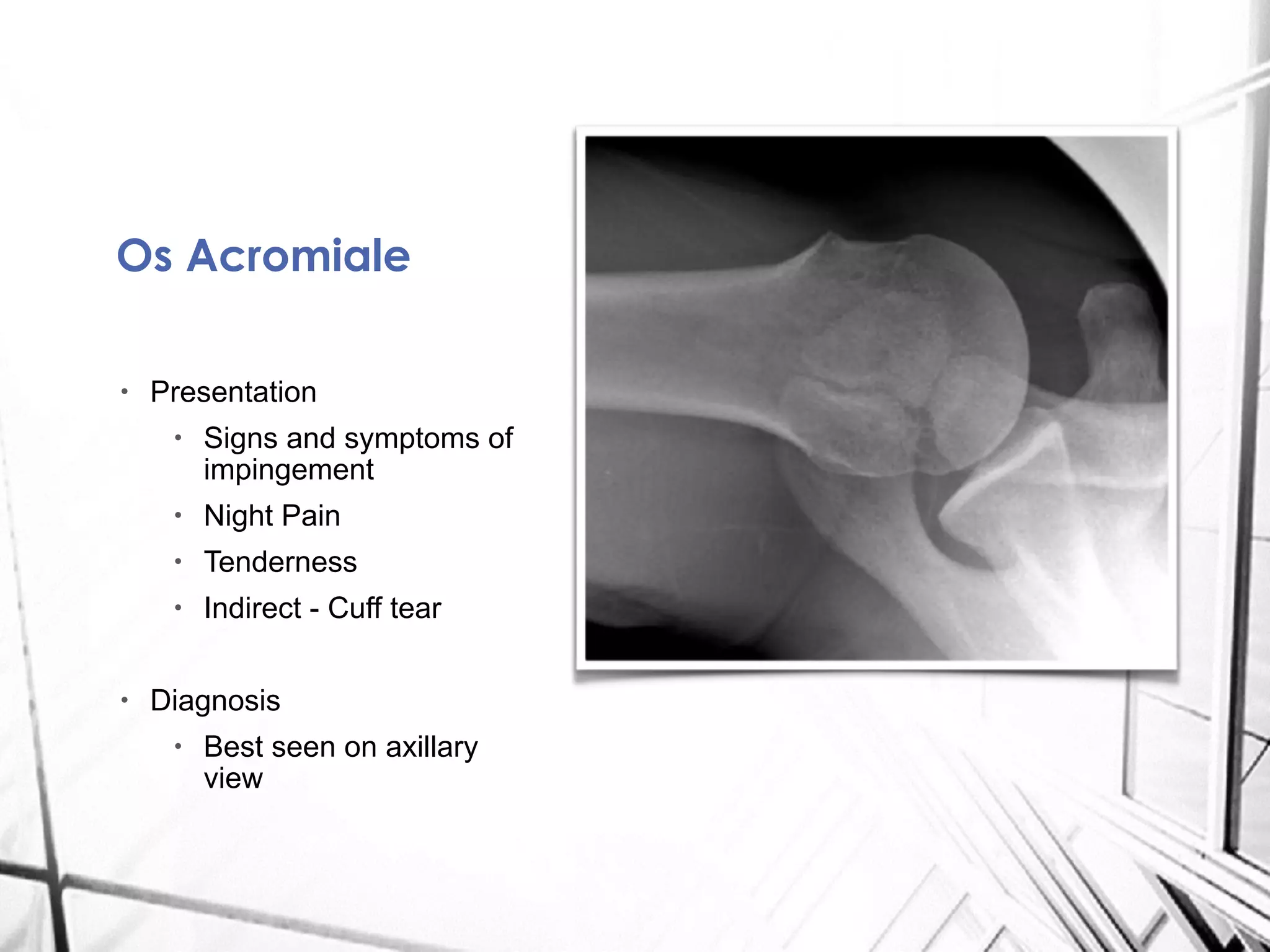 Acromion - Os-acromiale Fractures and Insufficiency | PDF