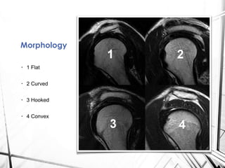 Acromion Types Mri