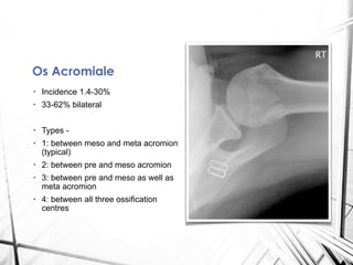 Acromion - Os-acromiale Fractures and Insufficiency | PDF