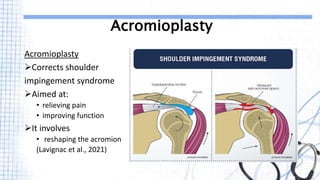 Open Acromioplasty Corrects shoulder impingement syndrome1.pptx | Death, Injury, or Military ...