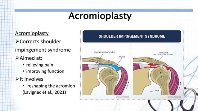 Open Acromioplasty Corrects shoulder impingement syndrome1.pptx