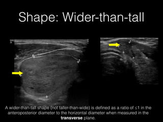 ACR TI-RADS Atlas.pdf