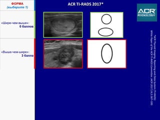 ACR TI-RADS and TBSRTS: 2019 | PPT