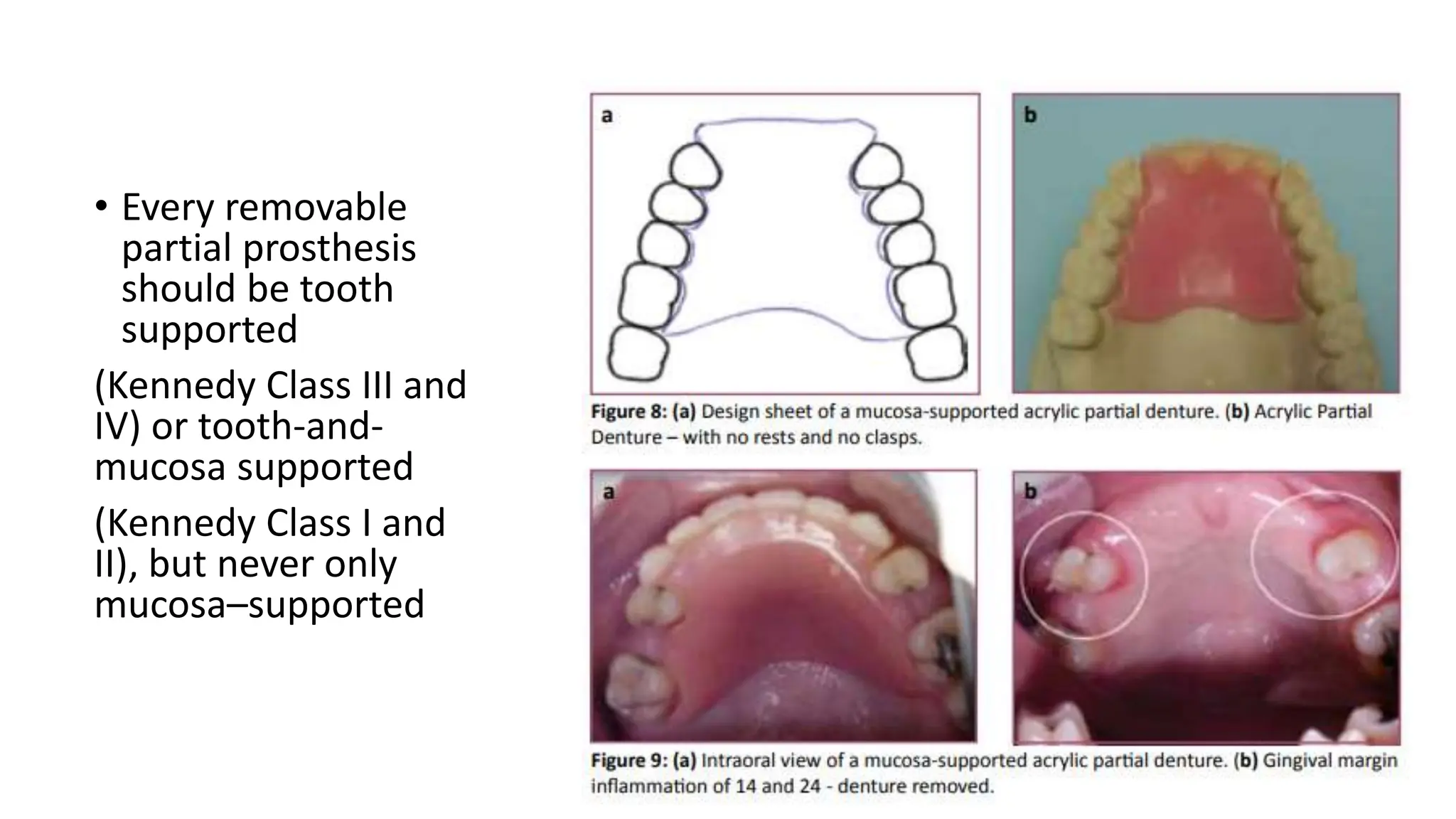 ACRYLIC PARTIAL DENTURES................ | PPTX