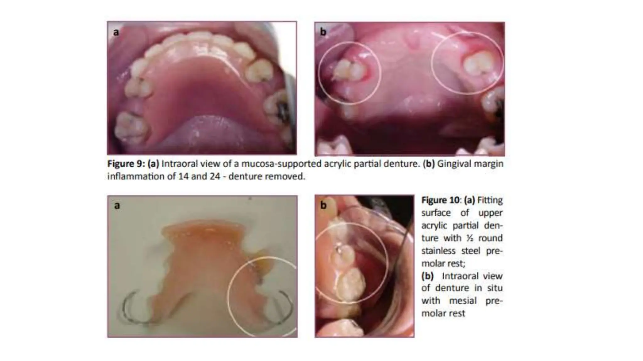 ACRYLIC PARTIAL DENTURES................ | PPTX