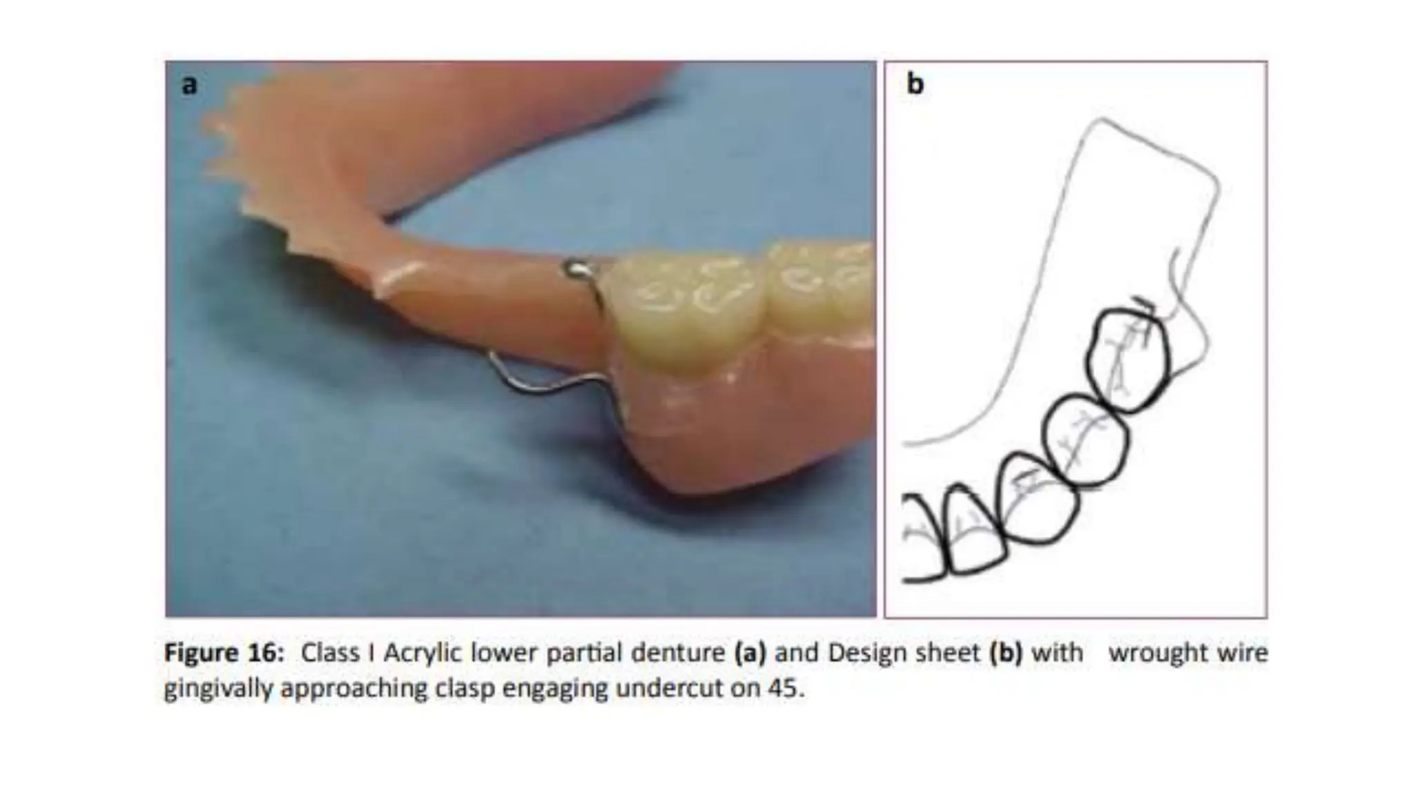 ACRYLIC PARTIAL DENTURES................ | PPTX