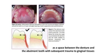 ACRYLIC PARTIAL DENTURES................ | PPTX