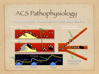 Acute Coronary Syndrome | PPT