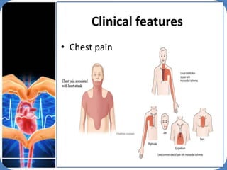 Acute coronary syndrome | PPTX