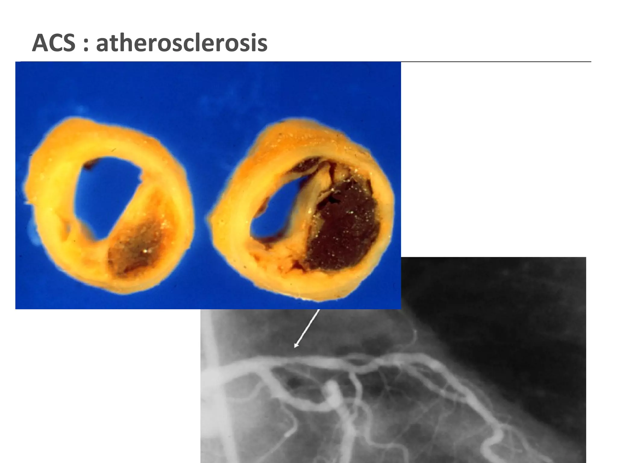 Acute Coronary Syndrome (ACS): Survival of the Species by Dione Nordby ...