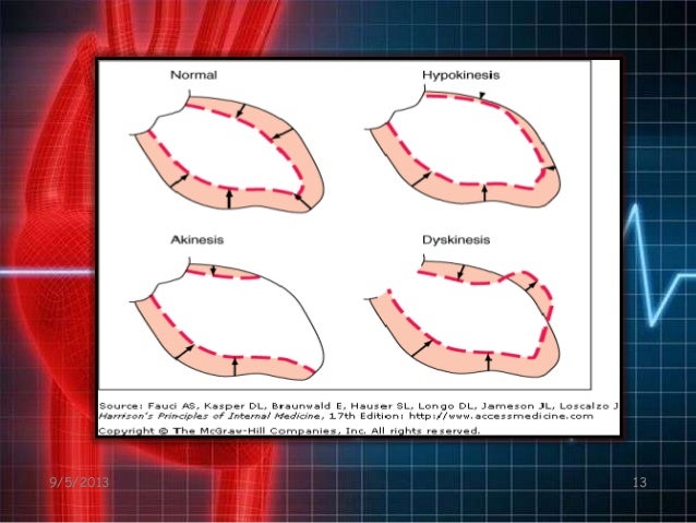 Acs – inferior wall myocardial infarction. by abhimanyu