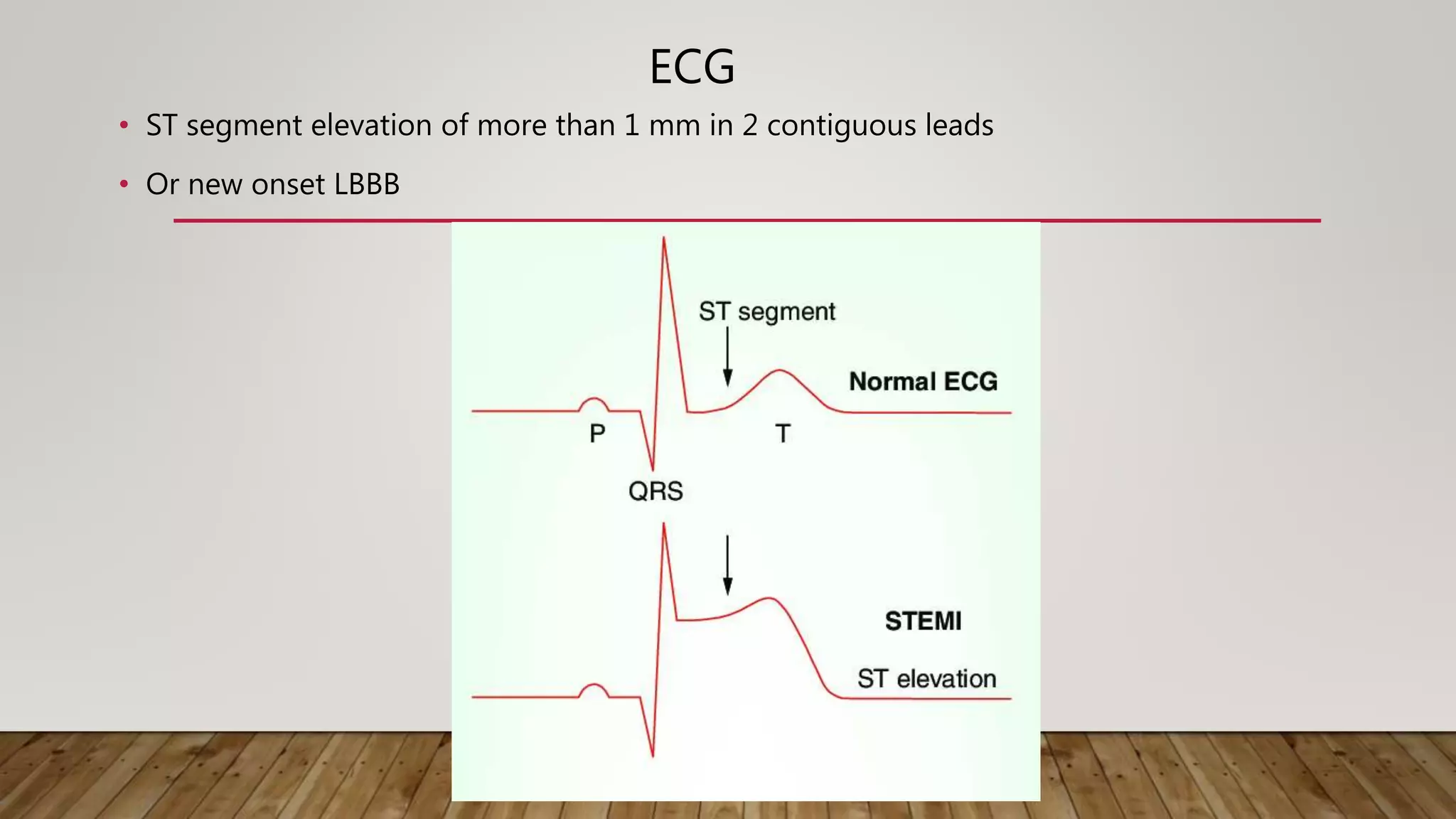 ACS:STEMI | PPT
