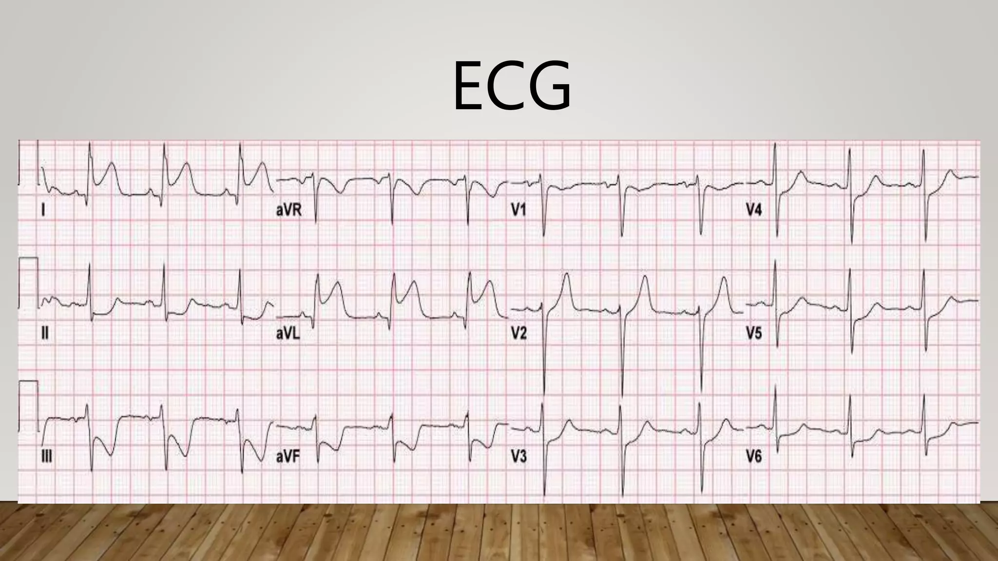 ACS:STEMI | PPT