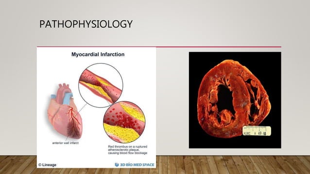 ACS:STEMI | PPT
