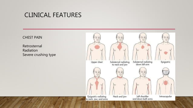 ACS:STEMI | PPT