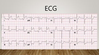 ACS:STEMI | PPT