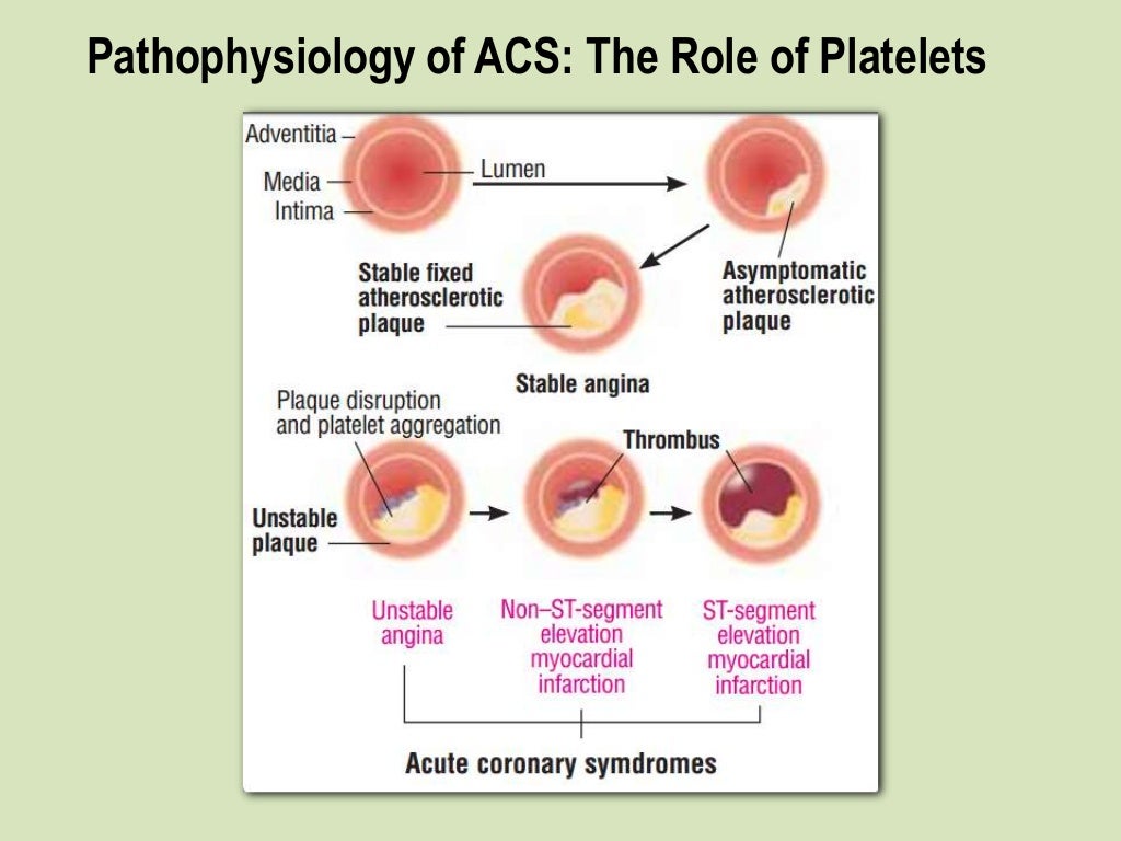 acute coronary syndrome 2015 overview