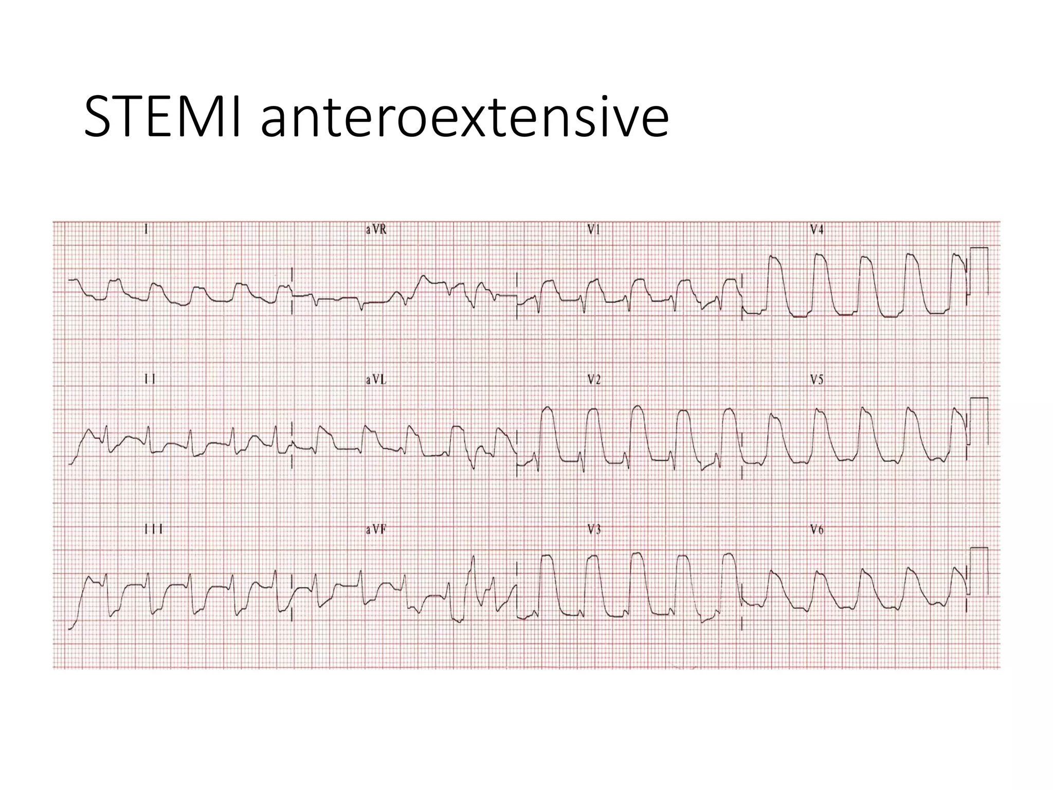 Acute coronary syndrome | PPT
