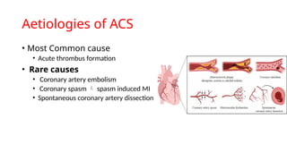 Acute Coronary syndrome explanation.pptx