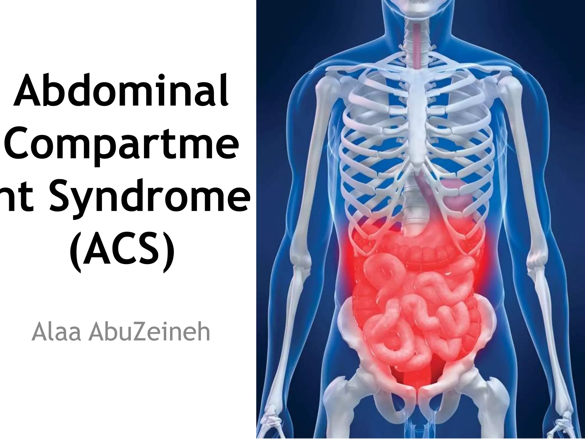 Abdominal Compartment Syndrome | PPTX
