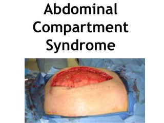 Abdominal Compartment Syndrome | PPTX