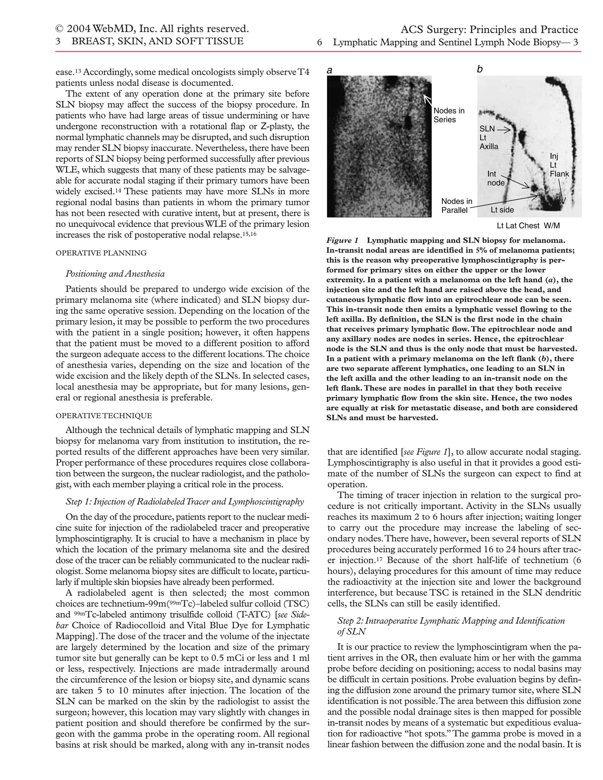 Acs0306 Lymphatic Mapping And Sentinel Lymph Node Biopsy | PDF