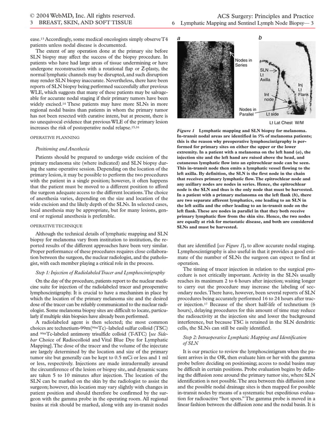 Acs0306 Lymphatic Mapping And Sentinel Lymph Node Biopsy | PDF
