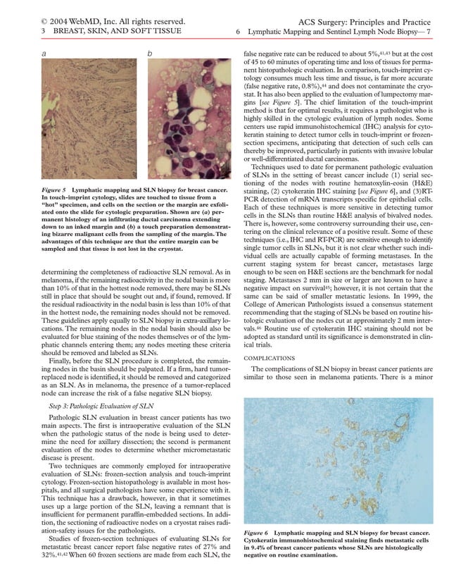 Acs0306 Lymphatic Mapping And Sentinel Lymph Node Biopsy | PDF