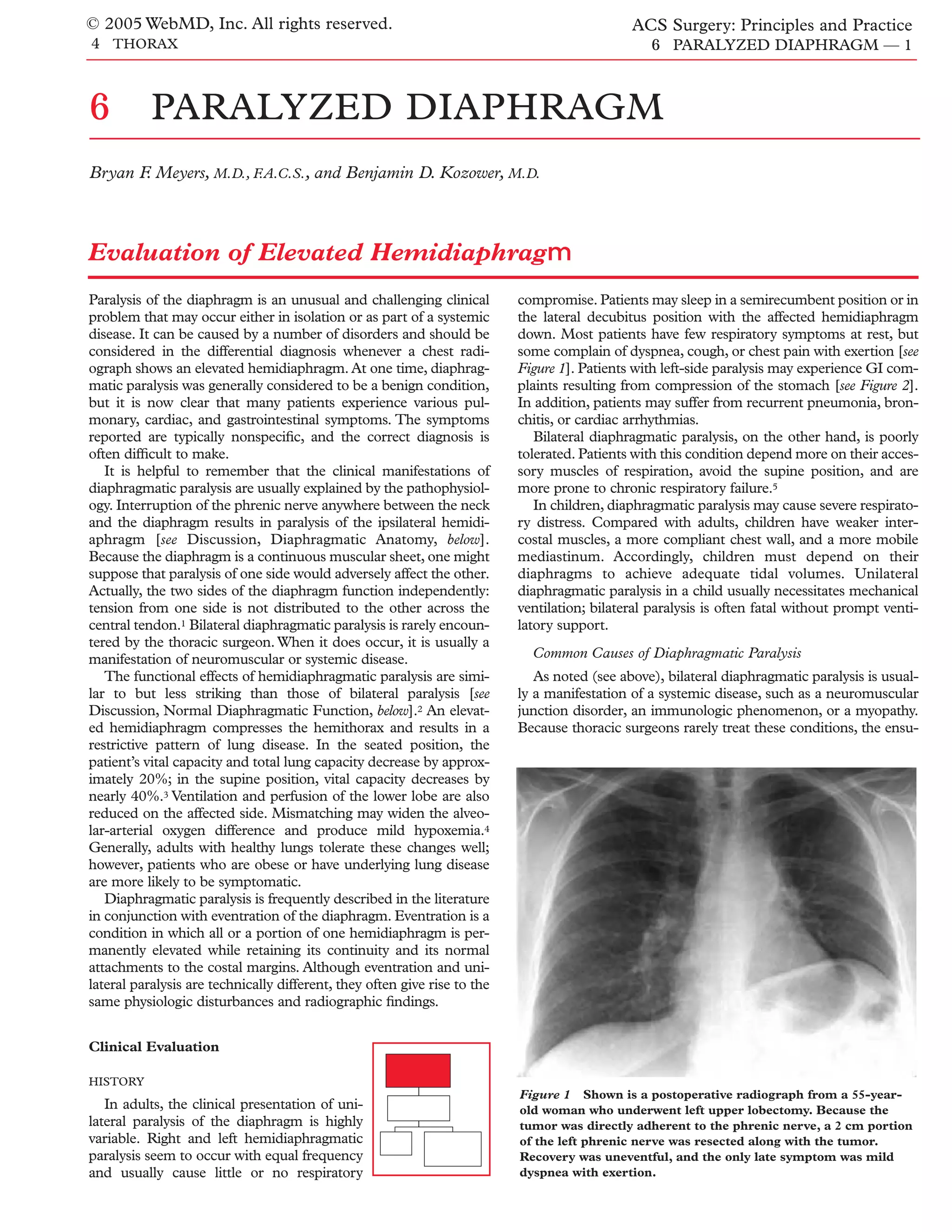 Acs0406 Paralyzed Diaphragm | PDF