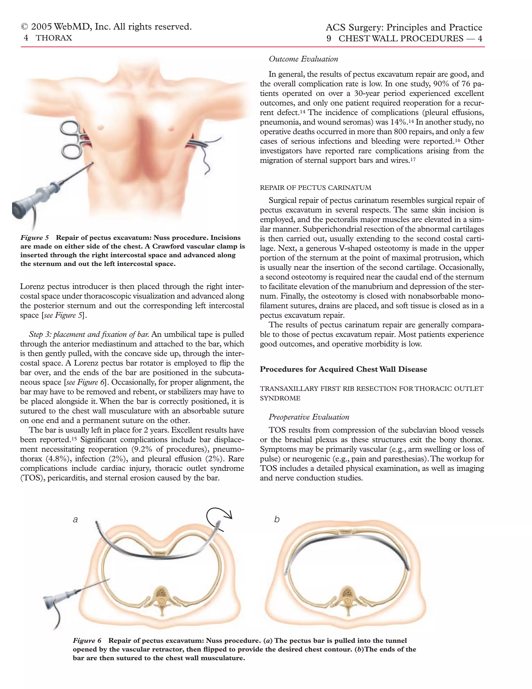 Acs0409 Chest Wall Procedures | PDF