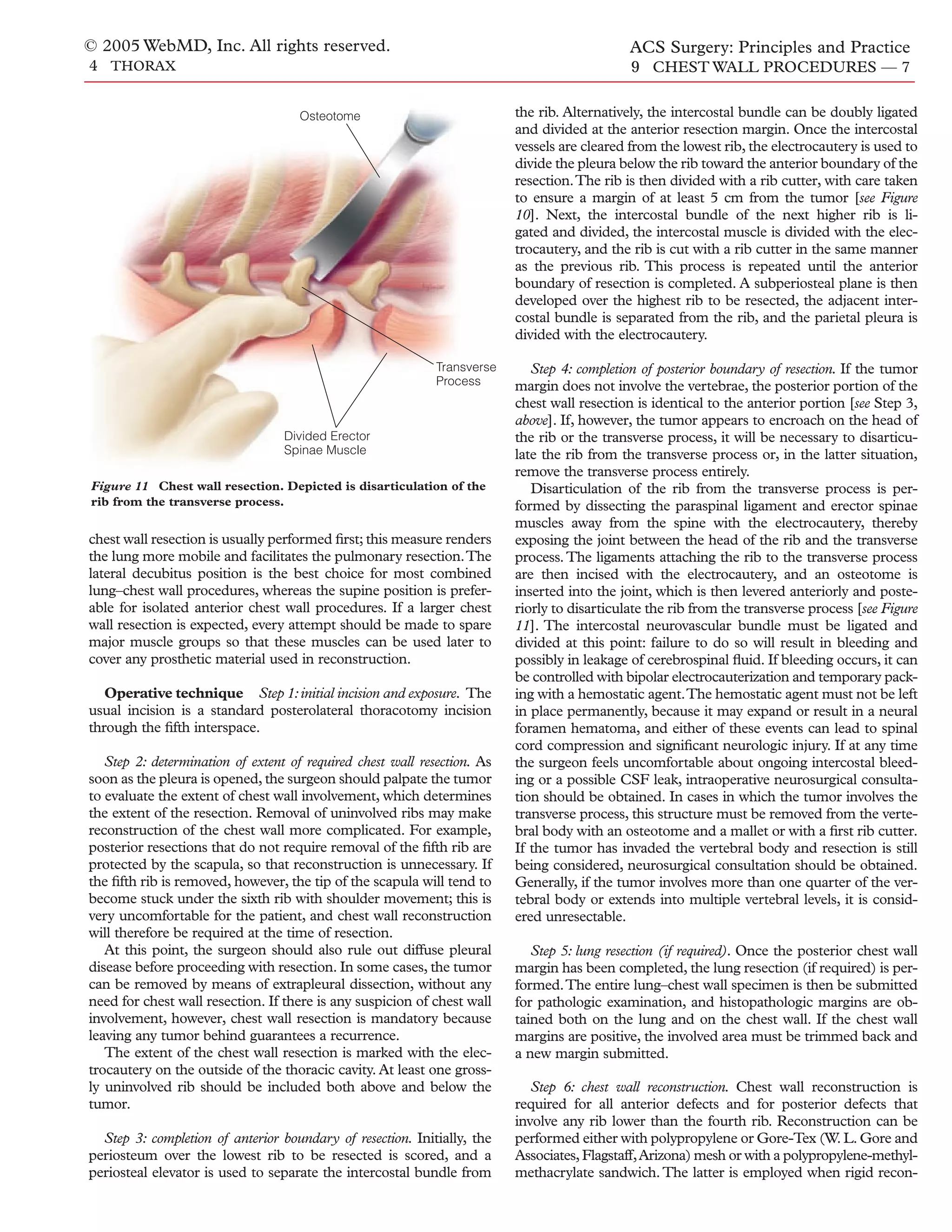 Acs0409 Chest Wall Procedures | PDF