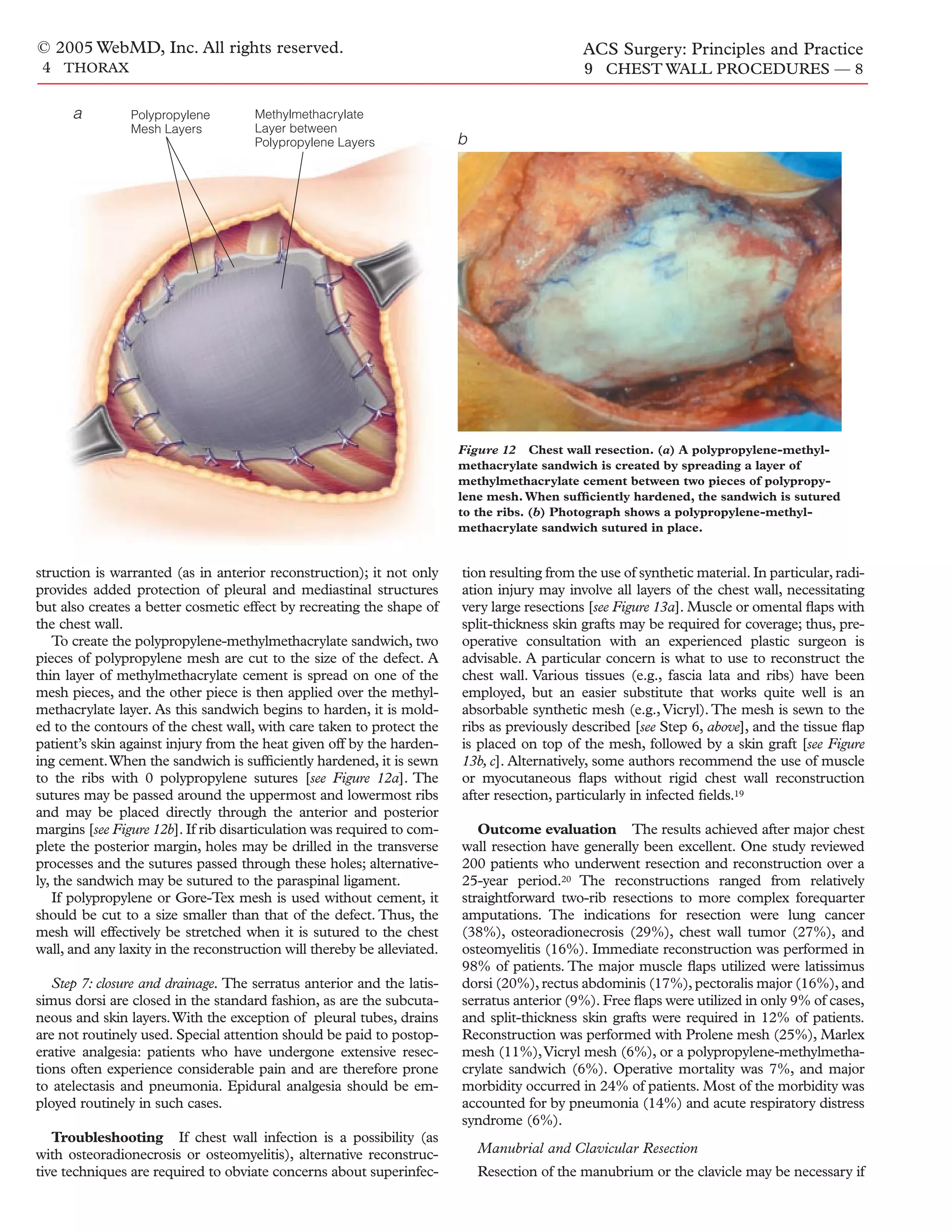 Acs0409 Chest Wall Procedures | PDF