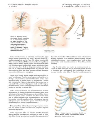Acs0409 Chest Wall Procedures | PDF