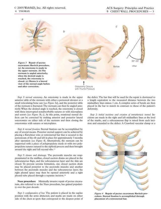 Acs0409 Chest Wall Procedures | PDF