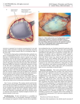Acs0409 Chest Wall Procedures | PDF