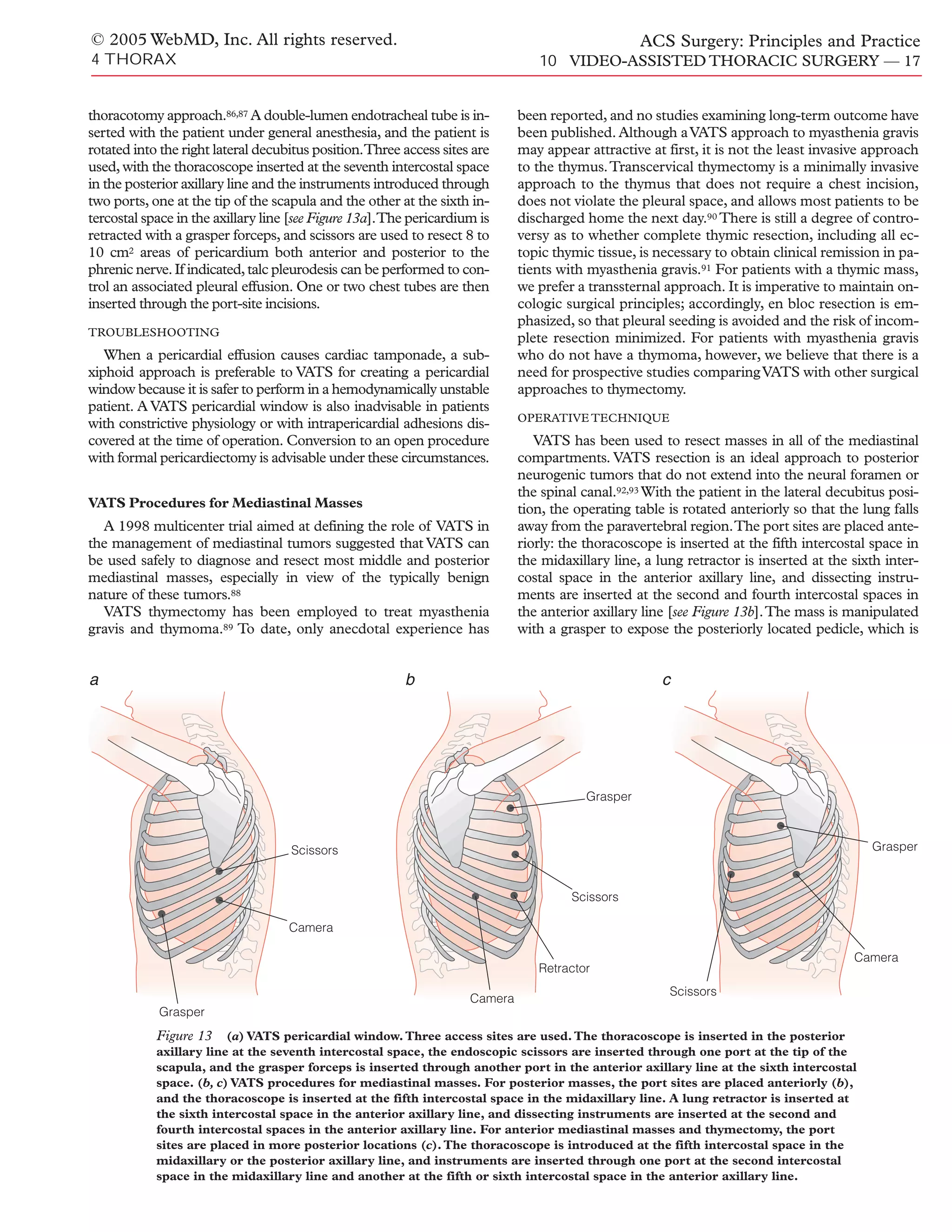 Acs0410 Video Assisted Thoracic Surgery | PDF