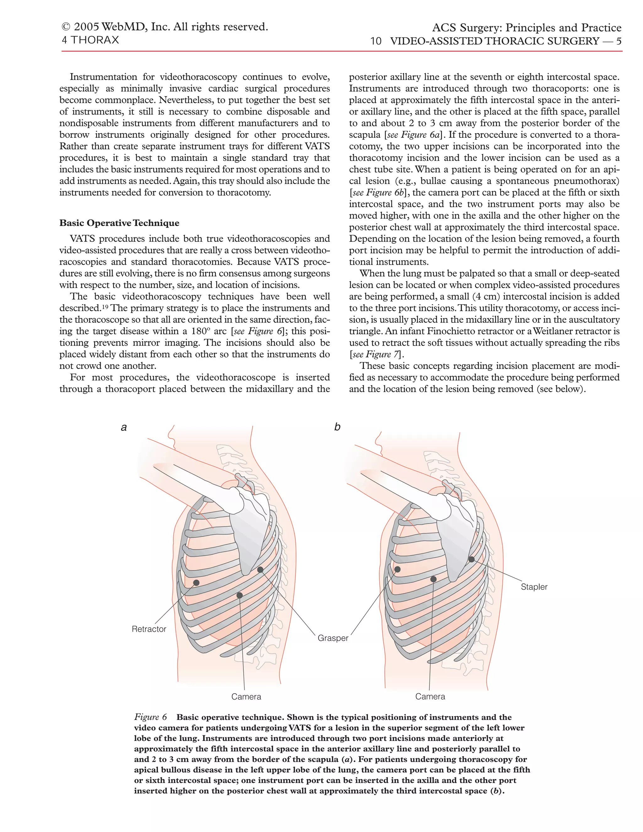 Acs0410 Video Assisted Thoracic Surgery | PDF