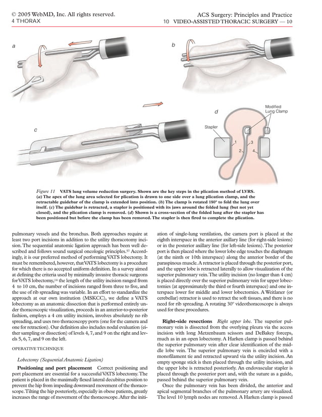 Acs0410 Video Assisted Thoracic Surgery | PDF
