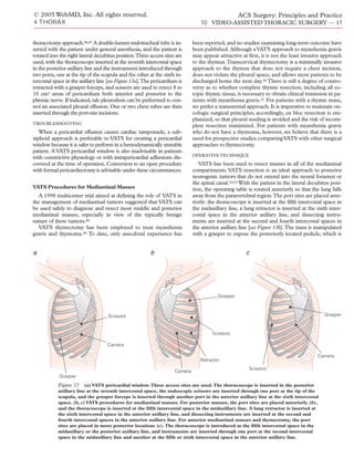 Acs0410 Video Assisted Thoracic Surgery | PDF