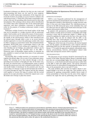 Acs0410 Video Assisted Thoracic Surgery | PDF