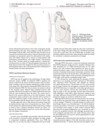 Acs0410 Video Assisted Thoracic Surgery | PDF