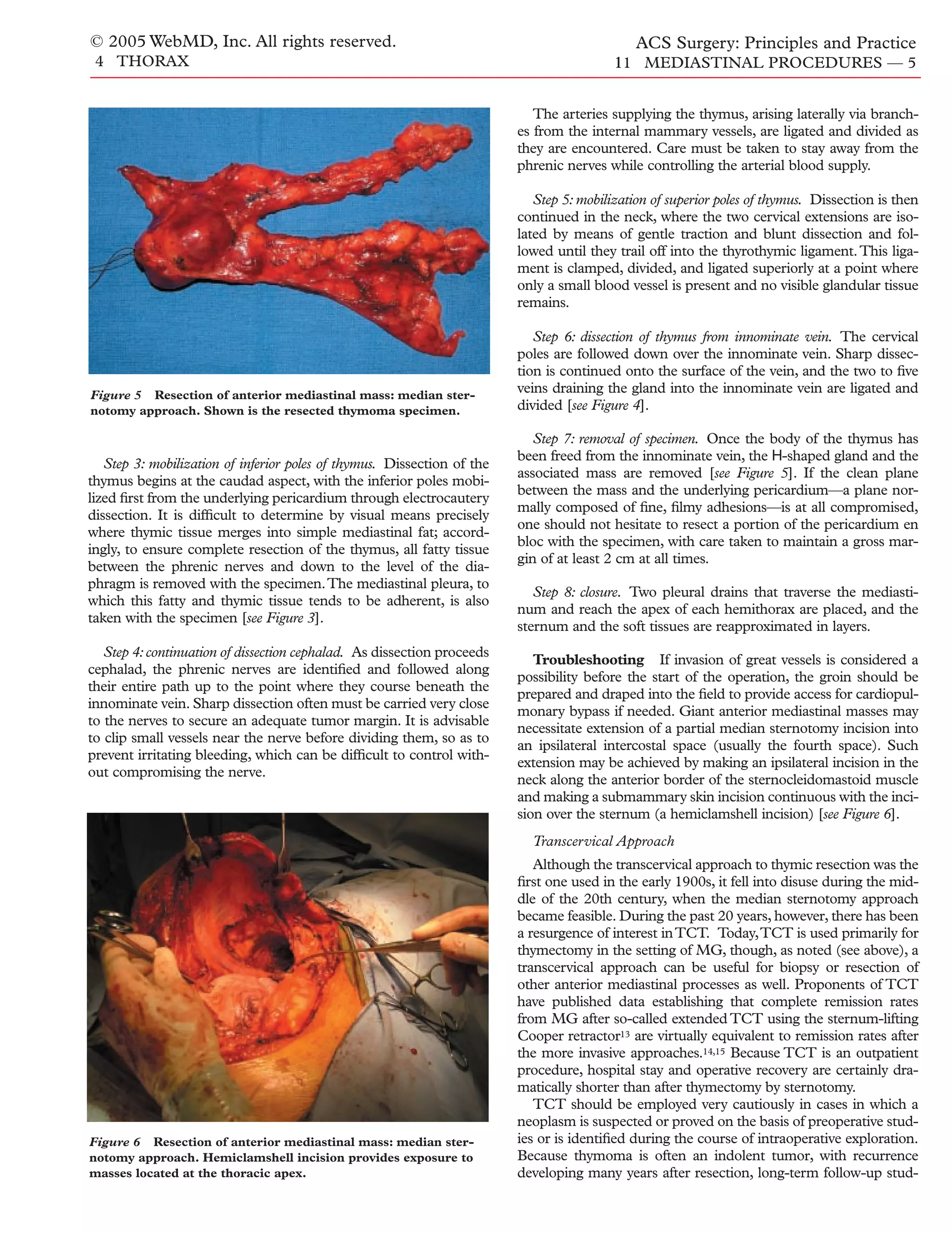 Acs0411 Mediastinal Procedures | PDF
