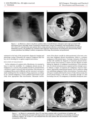 Acs0413 Decortication And Pleurectomy | PDF