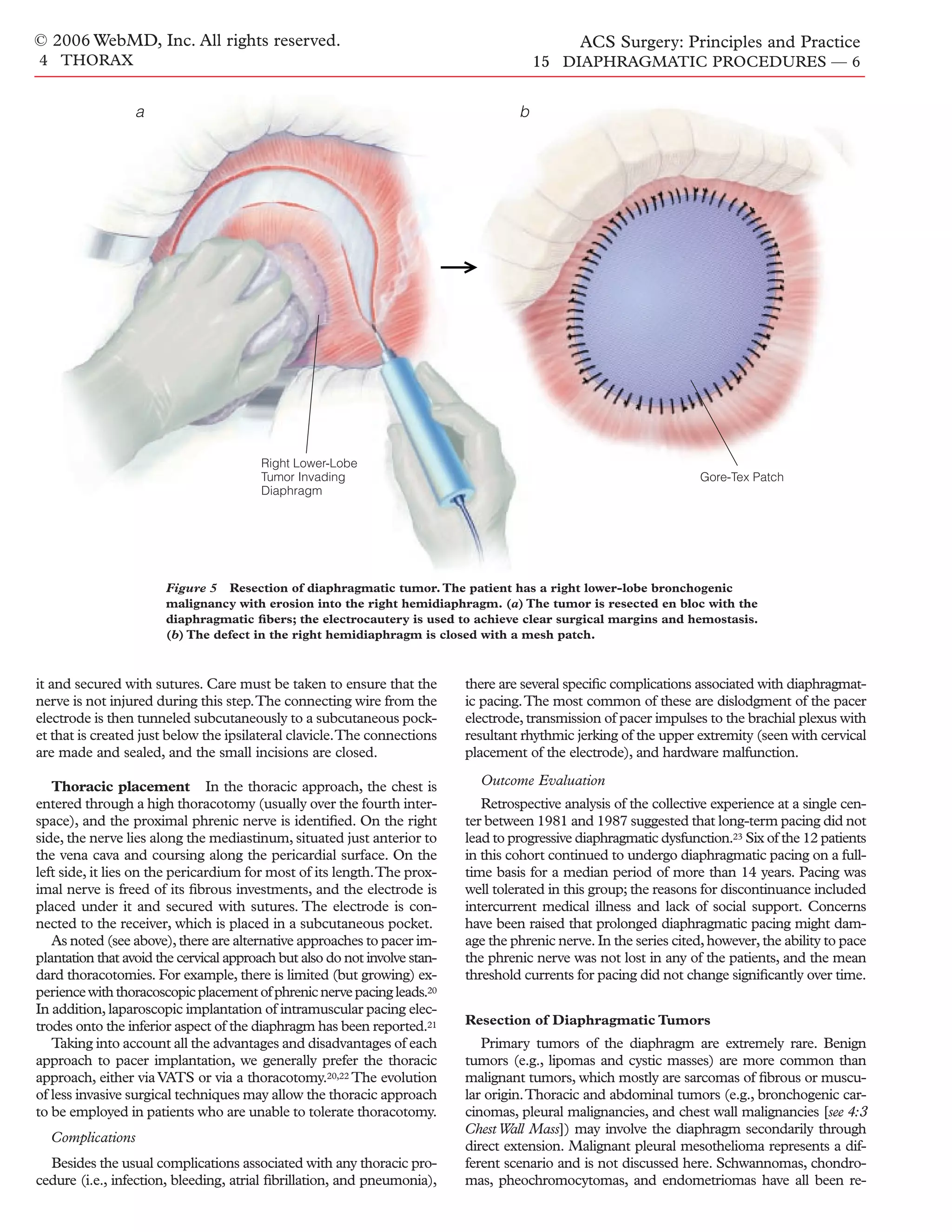Acs0415 Diaphragmatic Procedures | PDF