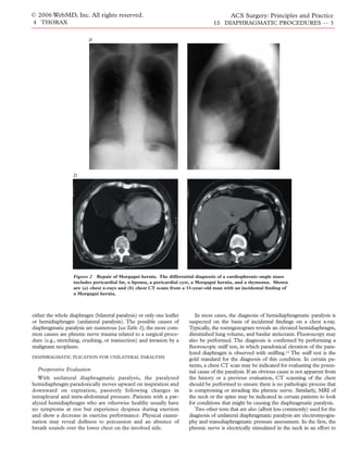 Acs0415 Diaphragmatic Procedures | PDF