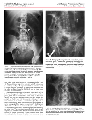 Acs0504 Intestinal Obstruction 2004 | PDF