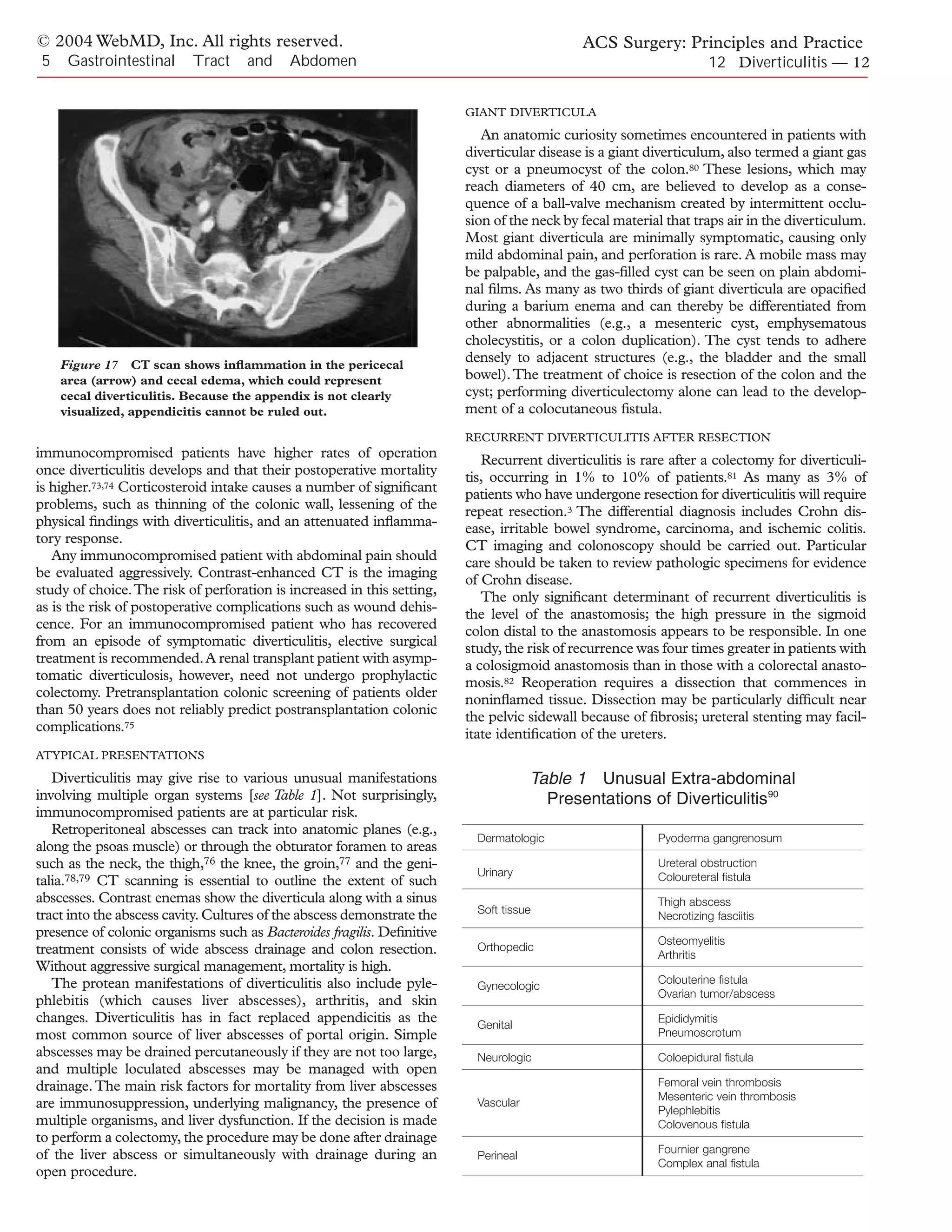Acs0512 Diverticulitis 2004 | PDF