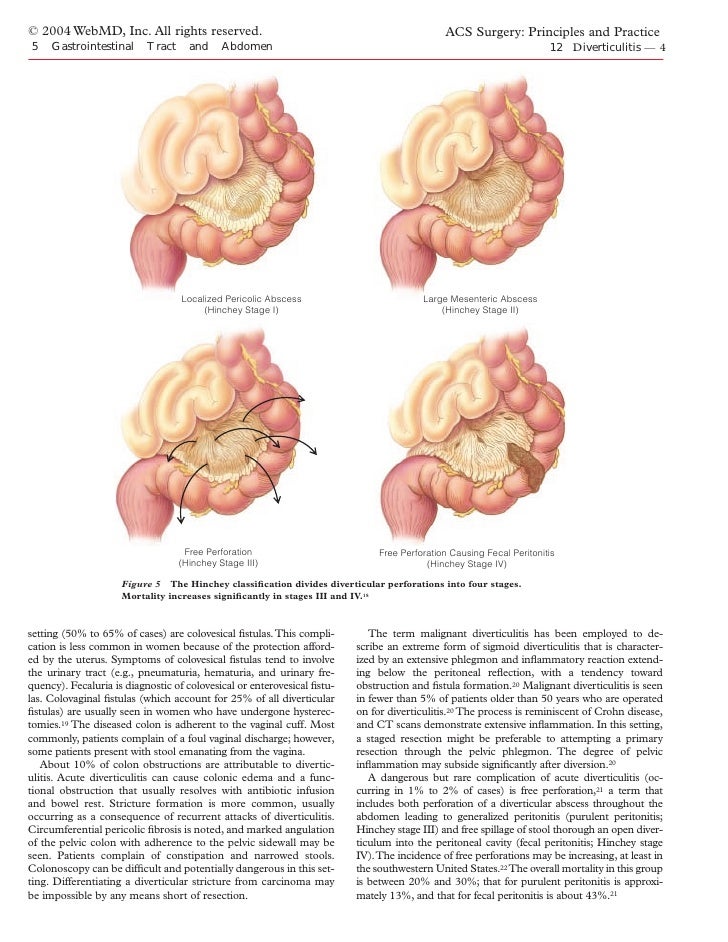 Acs0512 Diverticulitis 2004